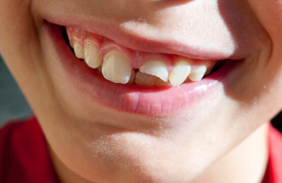 Como se livrar de manchas pretas nos dentes? - saudedia Como se livrar de manchas pretas nos dentes? - saudedia
